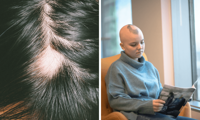 Alopecia - What is alopecia and what are its types? - Oxygeni Hair and Skin